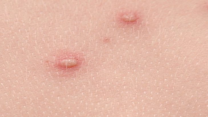 Su Çiçeği Hastalığı, Su Çiçeği Hastalığı Belirtileri ve Tedavisi ...