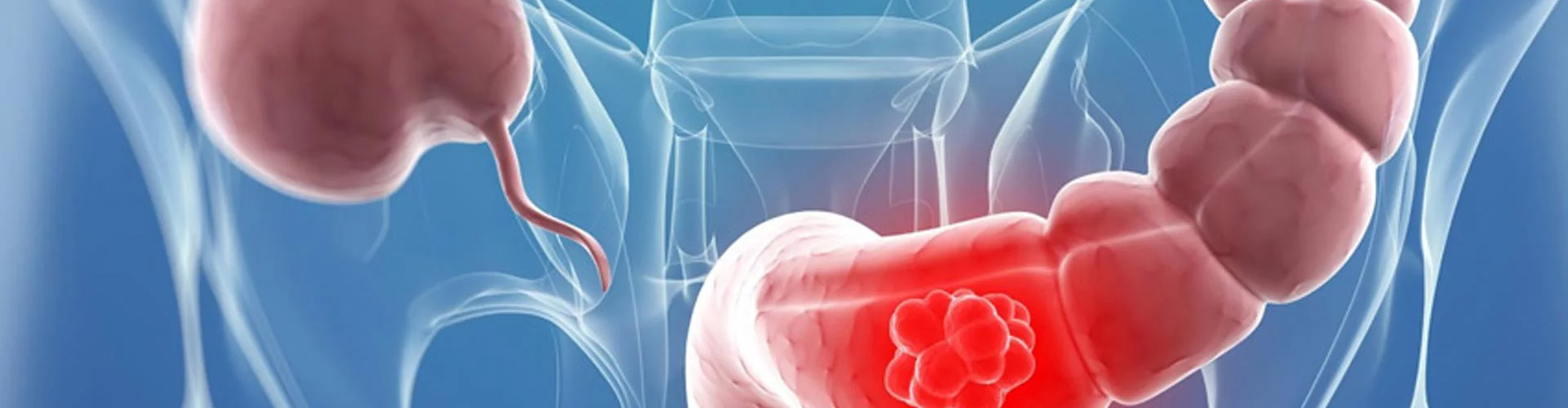 Ülseratif Kolit Hastalığı, Ülseratif Kolit Hastalığı Belirtileri ve ...